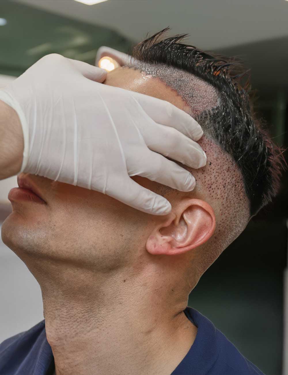 Hair Transplant Istanbul Cost 2026 | Vialife Clinic Transparent Pricing